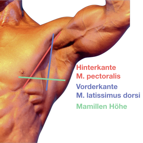 Thoraxdrainage im Notfall – Nerdfallmedizin Archiv