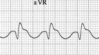 dominant-secondary-r-wave-in-avr-tca-toxicity – Nerdfallmedizin Archiv
