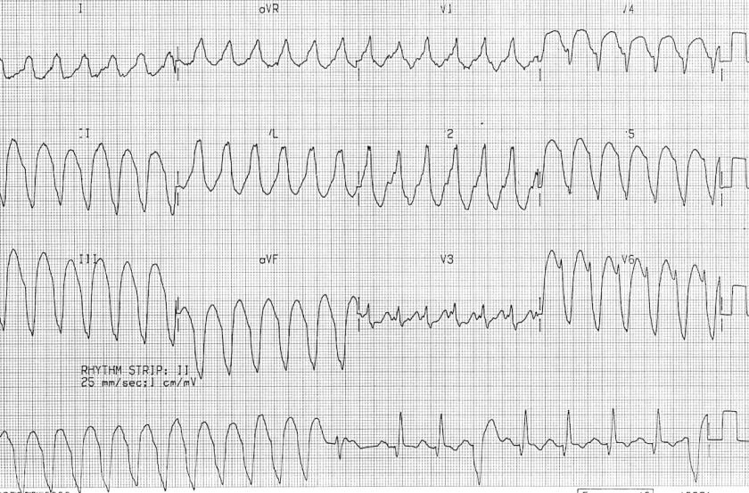 monomorphic-ventricular-tachycardia-vt-2 – Nerdfallmedizin Archiv