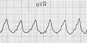 vereckei-avr-initial-r-wave-in-avr – Nerdfallmedizin Archiv