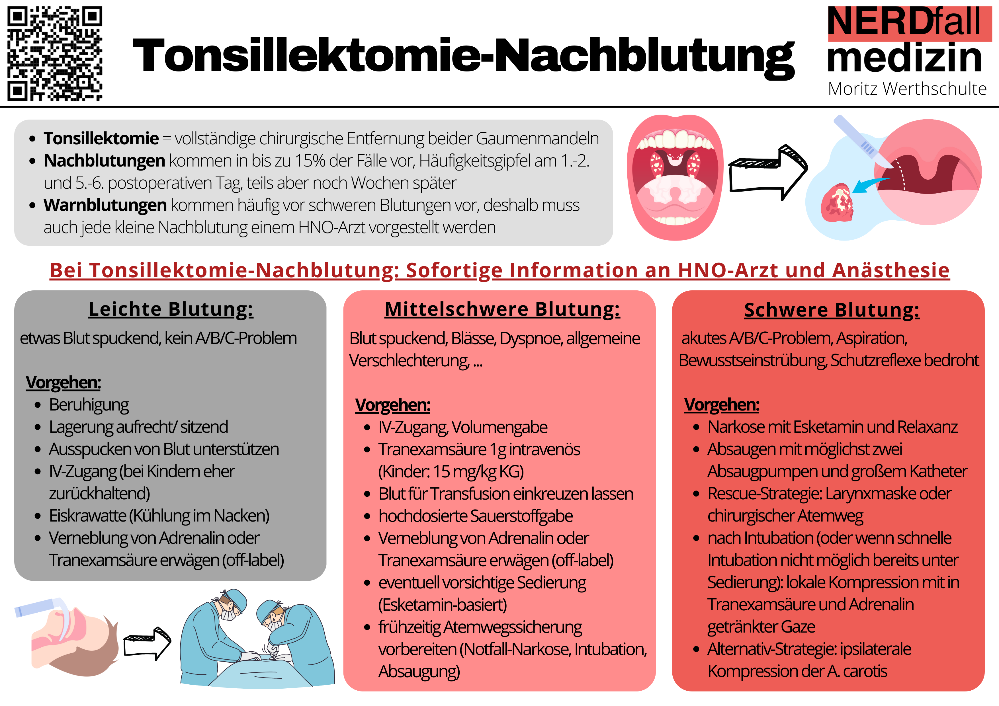 Infografik Tonsillektomie-Nachblutung – Nerdfallmedizin Archiv